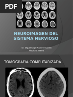 Escala ASPECTS | PDF