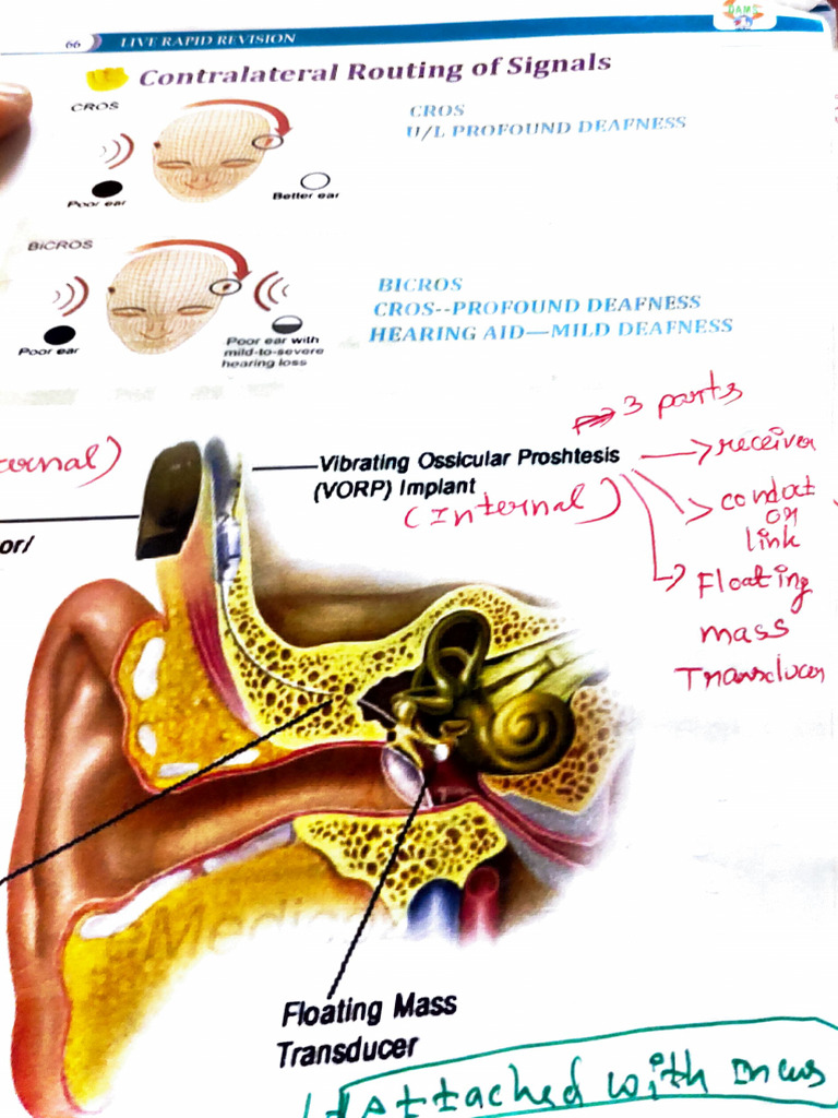 CROS and BICROS Hearing Solutions | PDF