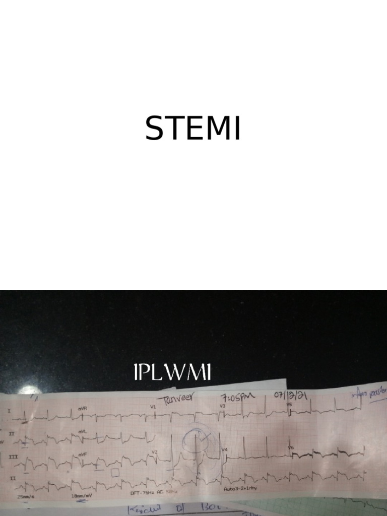 Stemi | PDF