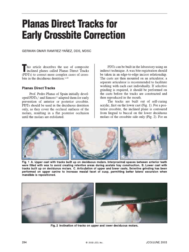Class III in Primary Dentition | PDF