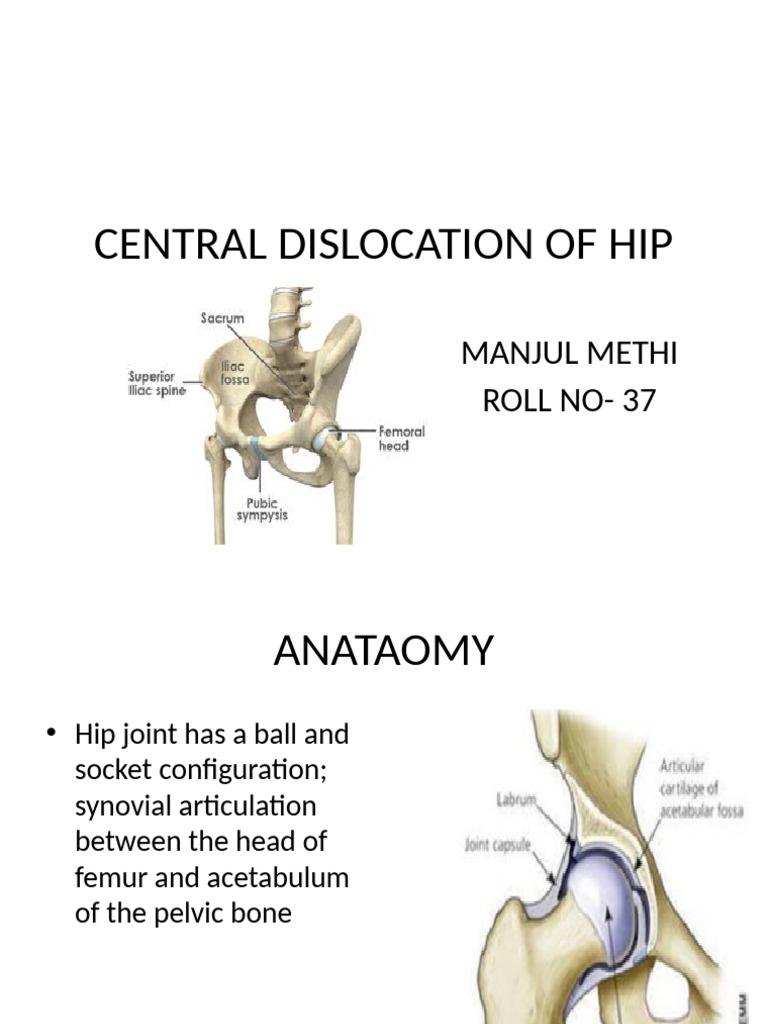 Central Dislocation of Hip | PDF