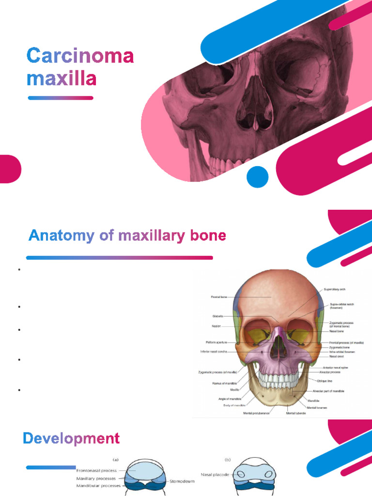 Carcinomamaxilla 220423134135 | PDF | Human Nose | Radiation Therapy