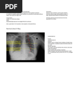 Costophrenic Angle Blunting Causes | PDF | Radiology | Lung