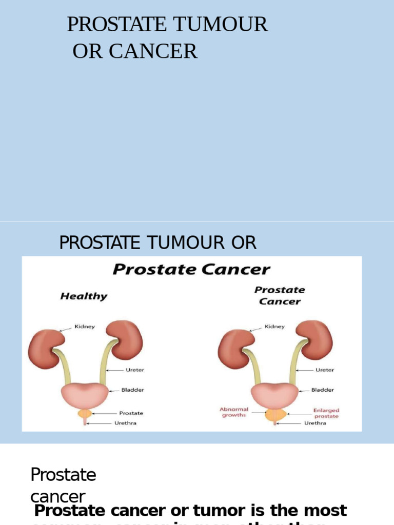 Prostate Cancer: Causes, Symptoms, and Treatment | PDF | Prostate ...