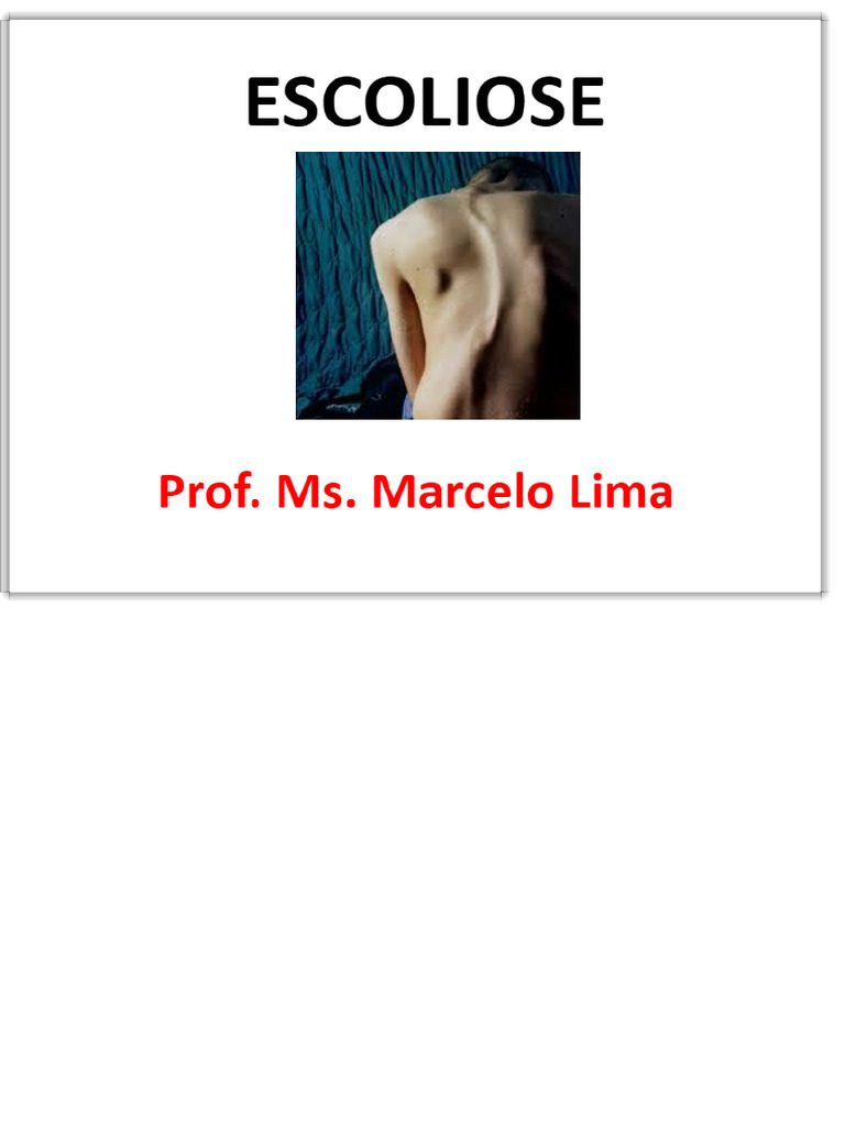 ESCOLIOSE. Prof. Ms. Marcelo Lima - PDF Download Grátis | PDF