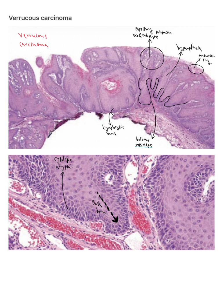 Verrucous Carcinoma | PDF