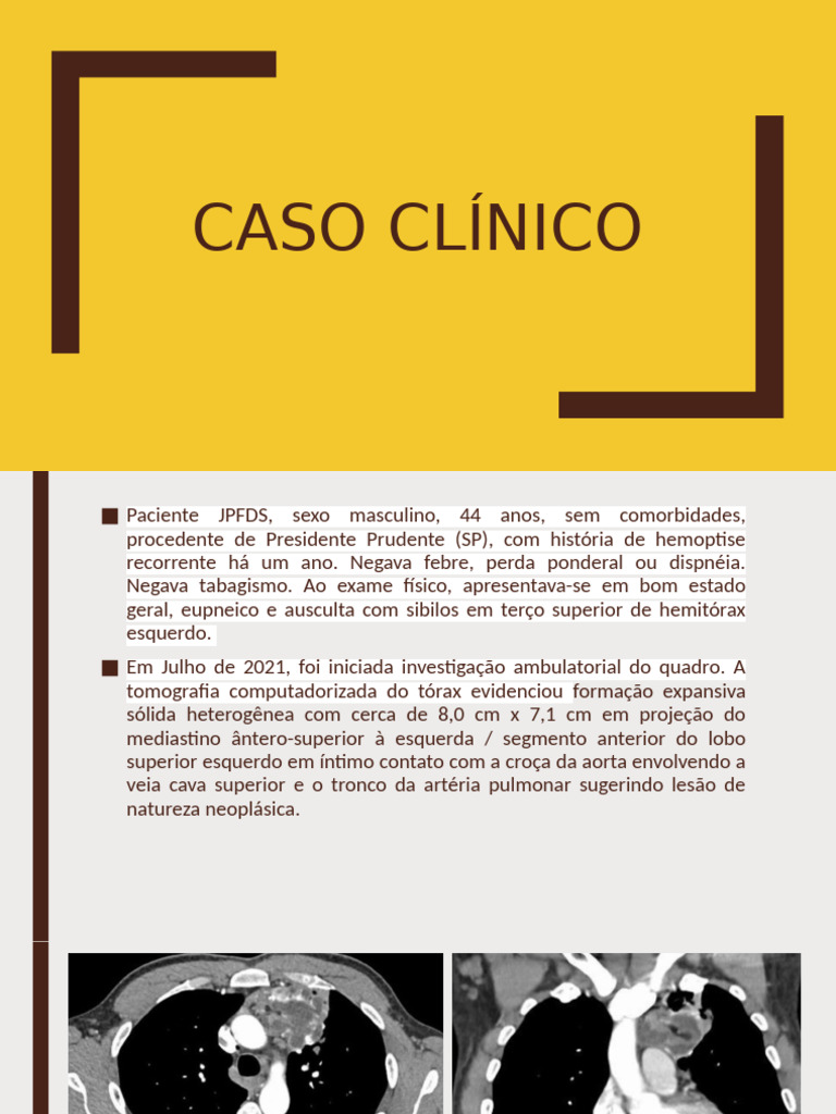 Tumores e Cistos Do Mediastino | PDF | Neoplasmas | Anatomia