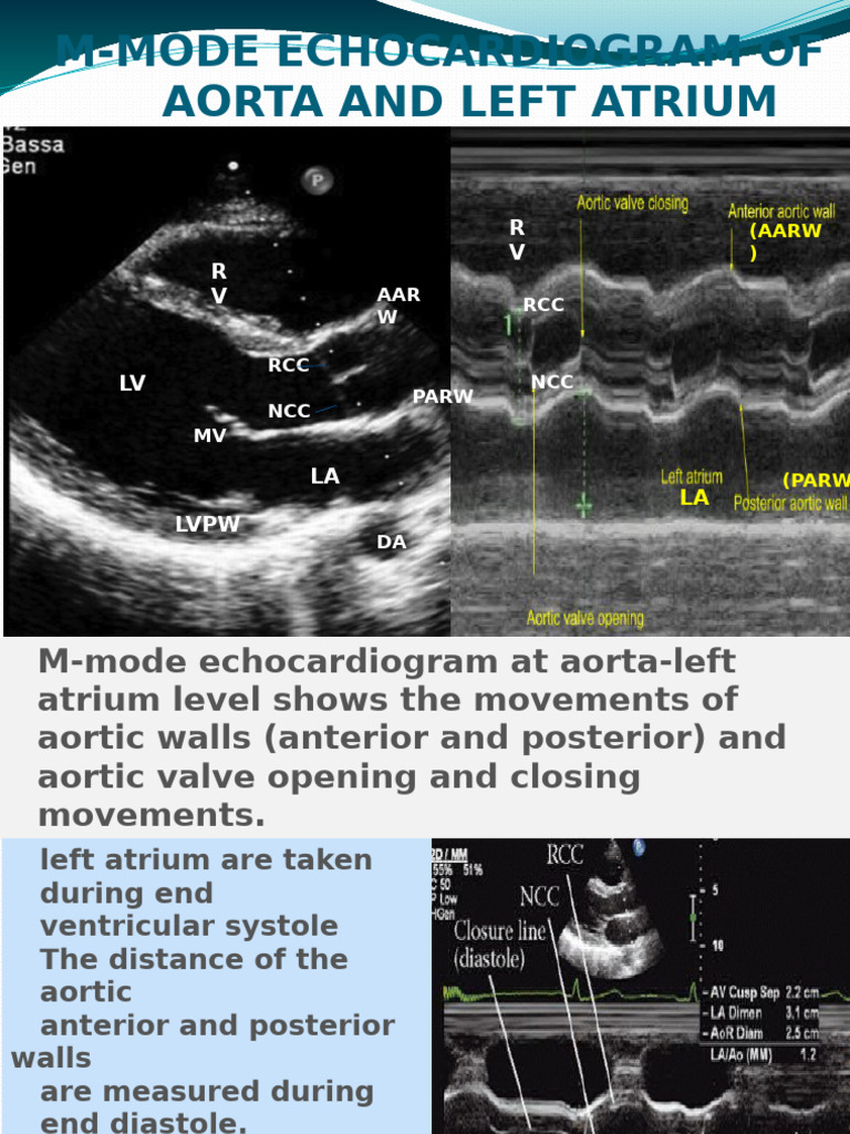 M mode of the AO LA & MV(8) | PDF | Heart Valve | Diastole