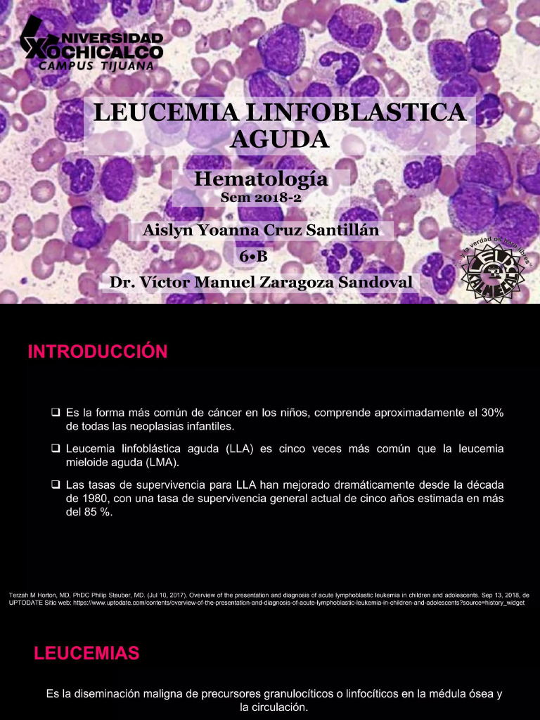 Leucemia Linfoblastica aguda | PDF