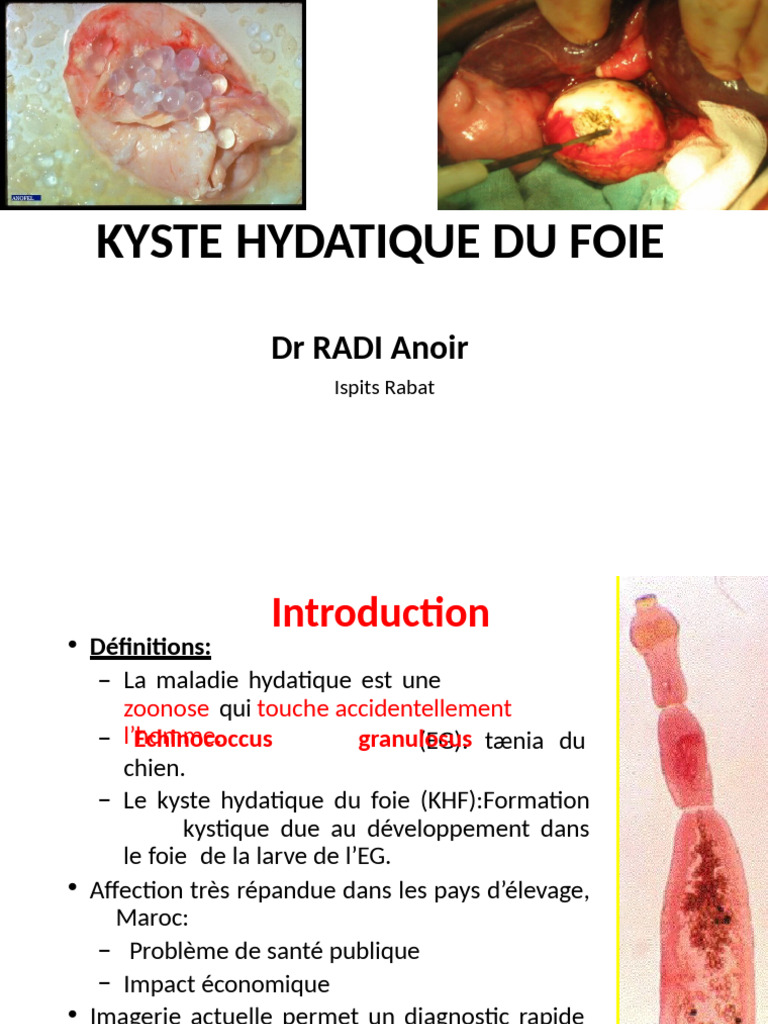 Kyste Hydatique: Diagnostic et Traitement | PDF | Vésicule biliaire ...