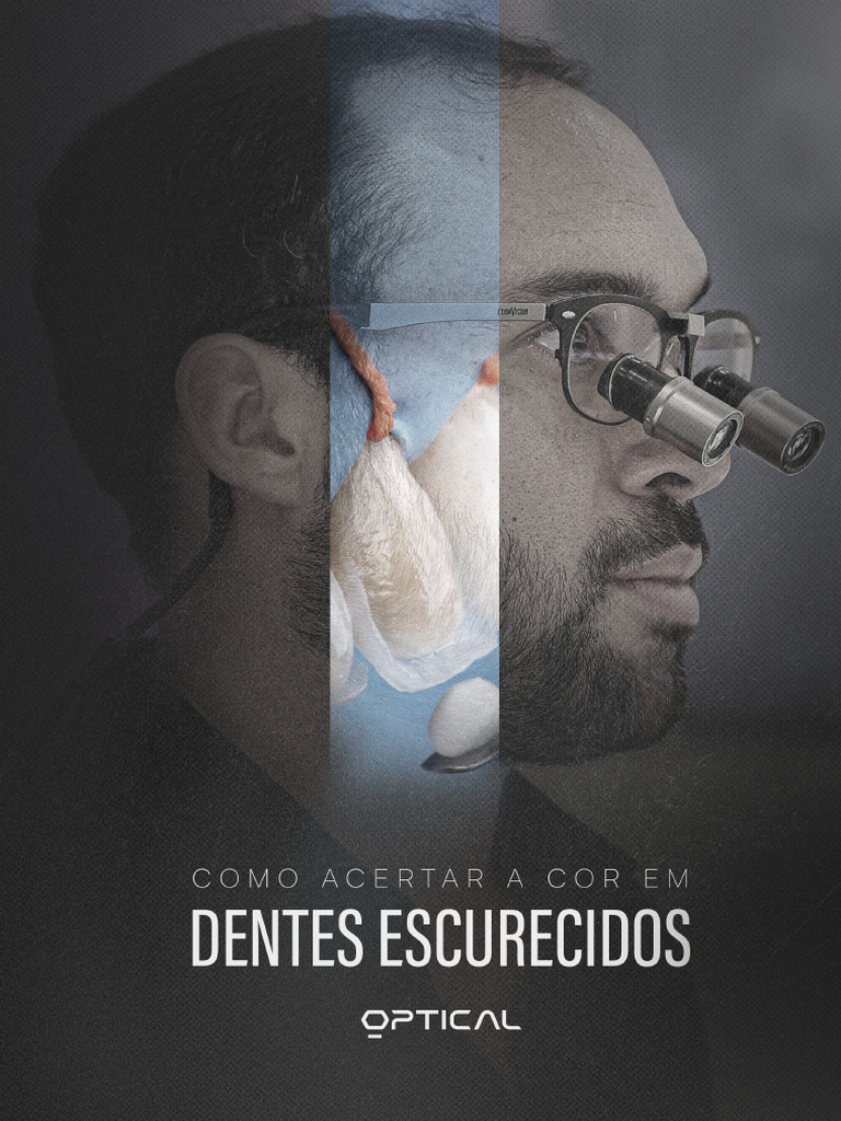 Manual: Como Acertar A Cor em Dentes Escurecidos | PDF | Dente humano | Cor