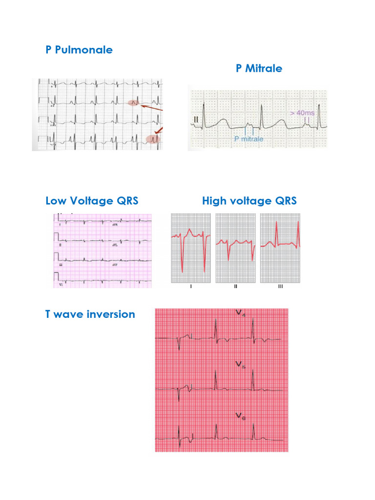 P Pulmonale P Mitrale | PDF