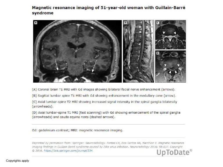 MRI of GBS | PDF