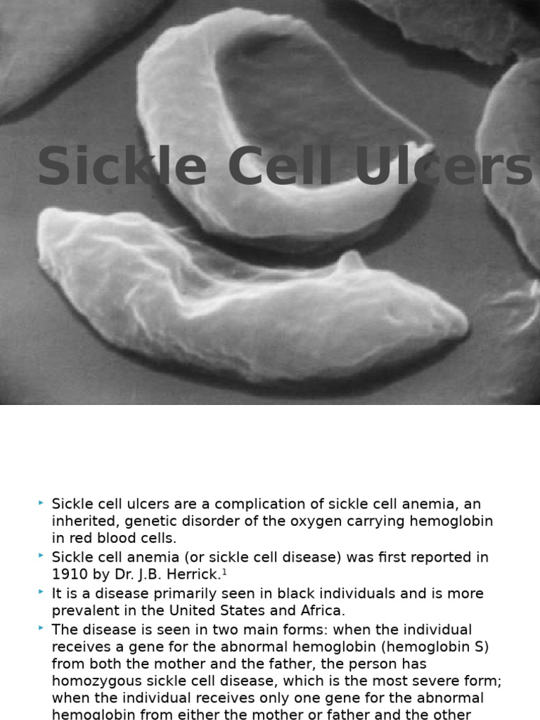 Lec 14 sickle. cell ulcers | PDF | Wound | Anemia
