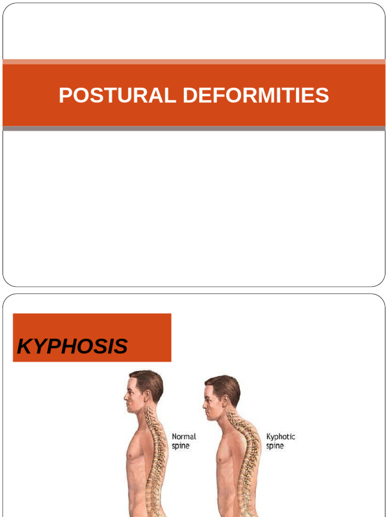 Postural Deformities 2 | PDF | Scoliosis | Vertebral Column
