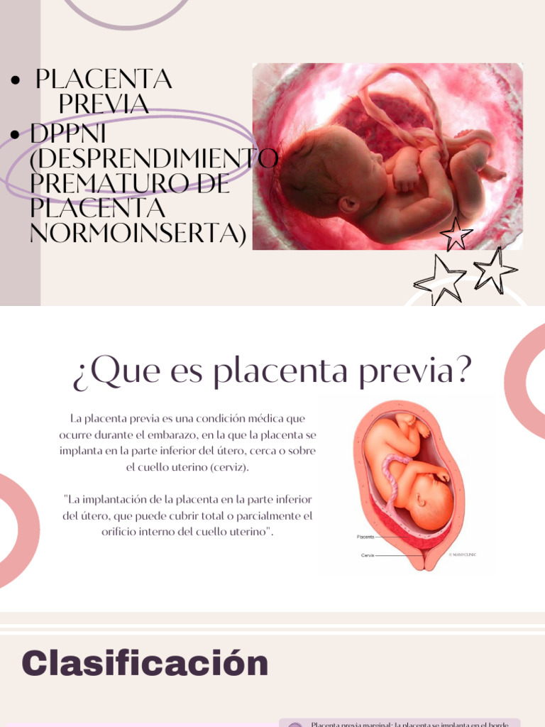 Dppni Desprendimiento Prematuro de Placenta Normoinserta PDF | PDF | El ...