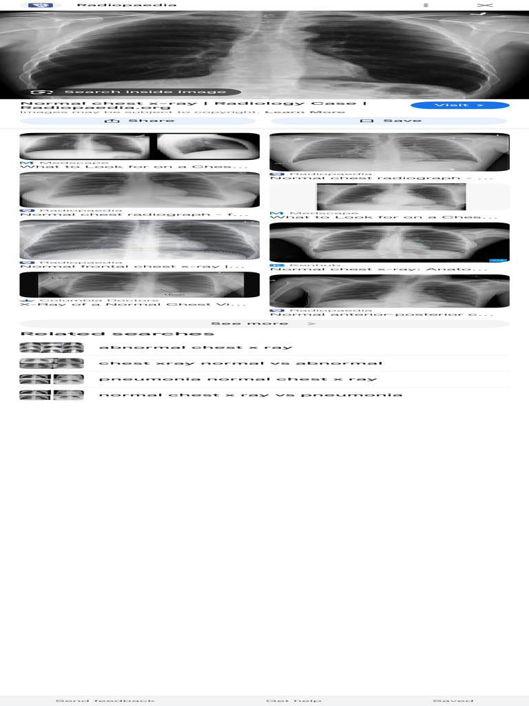Normal Chest X Ray - Google Search | PDF
