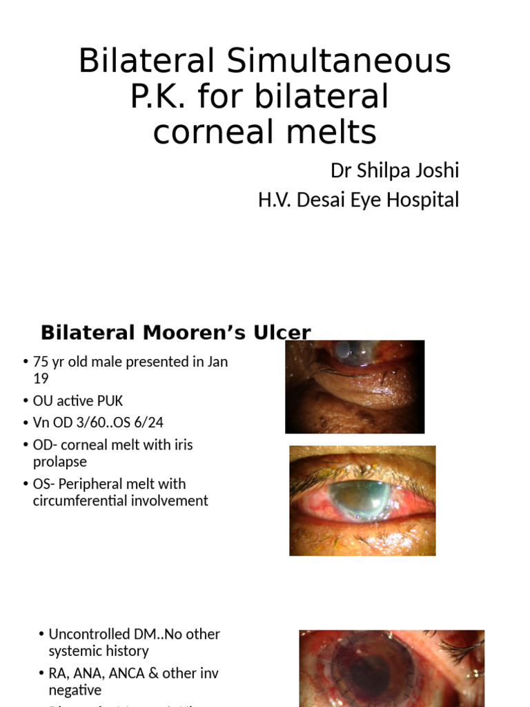 Bilateral Simultaneous Tectonic PK for Mooren's Ulcer | PDF