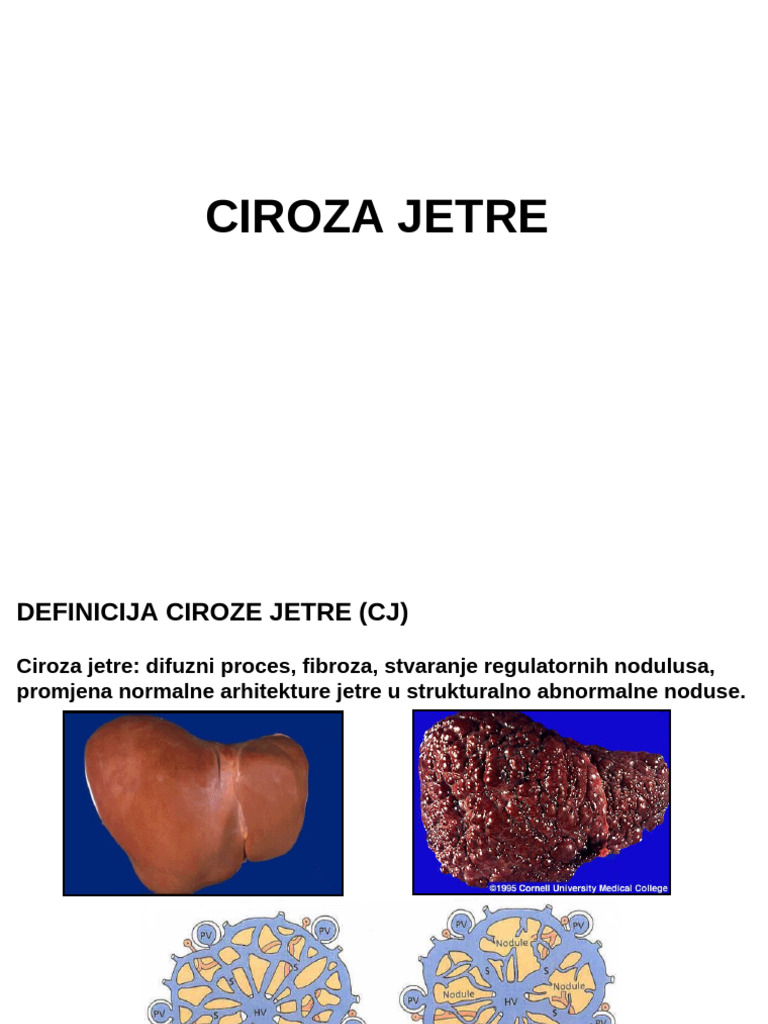 Ciroza Jetre | PDF