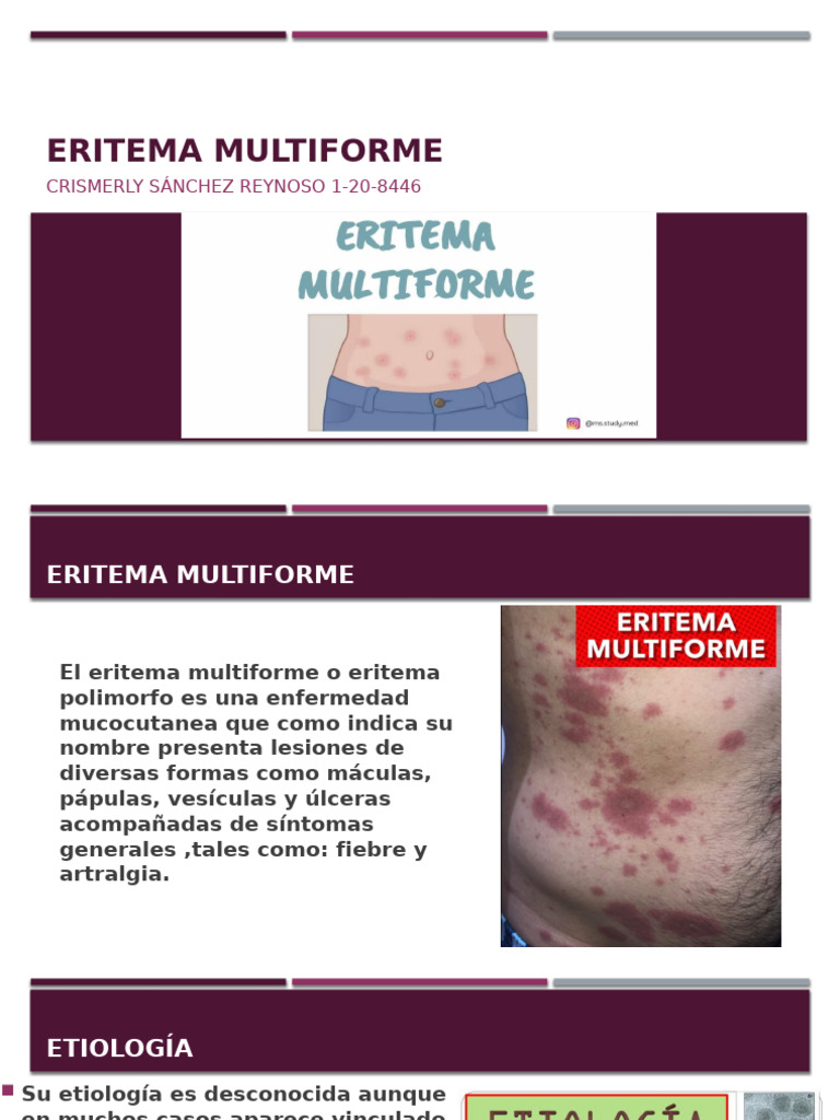 Eritema Multiforme | PDF