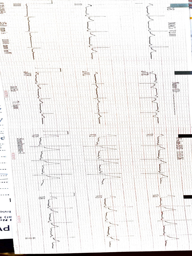 ECG Report | PDF