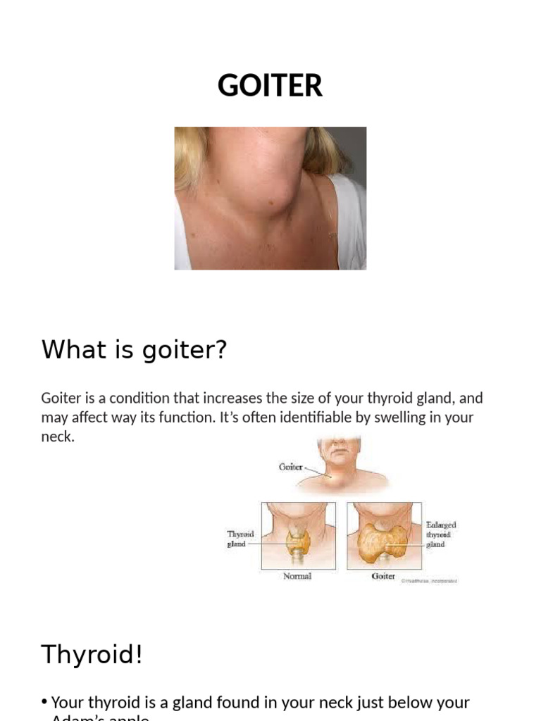 Goiter | PDF | Thyroid | Hyperthyroidism