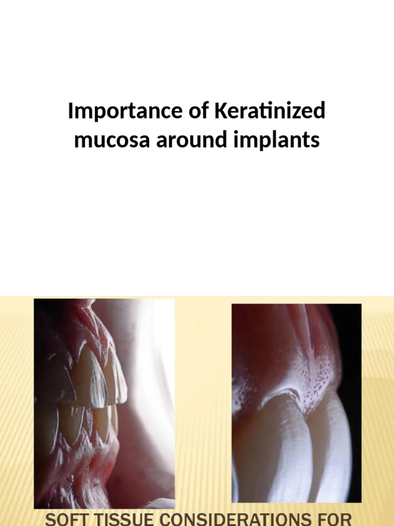 Importance of Keratinized Mucosa Around Implants | PDF