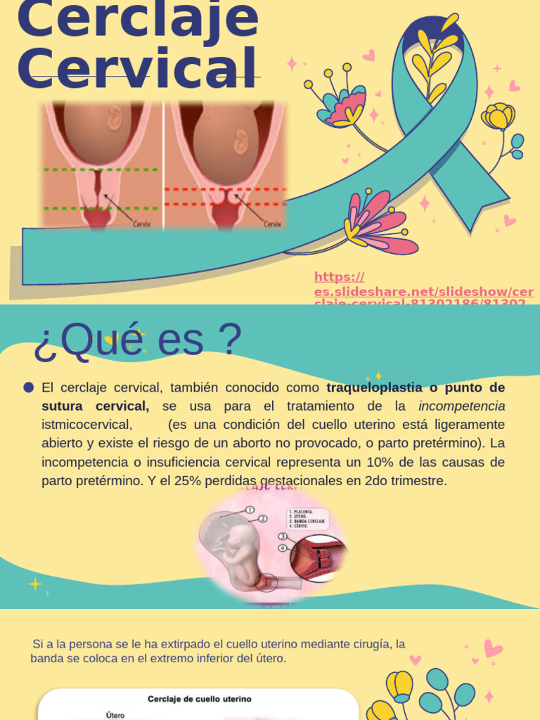 Cerclaje Cervical: Tipos y Cuidados | PDF | Parto | Parto prematuro