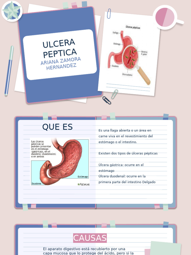 ULCERA PEPTICA | PDF | Gastroenterología | Especialidades Medicas