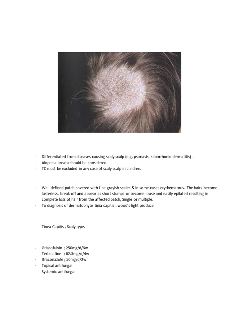 Tinea Capitis | PDF