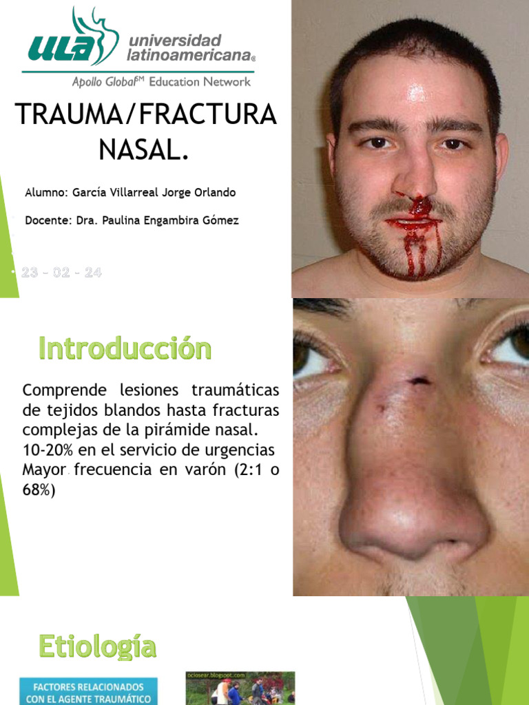 Trauma Nasal | PDF | Nariz humana | Enfermedades y trastornos