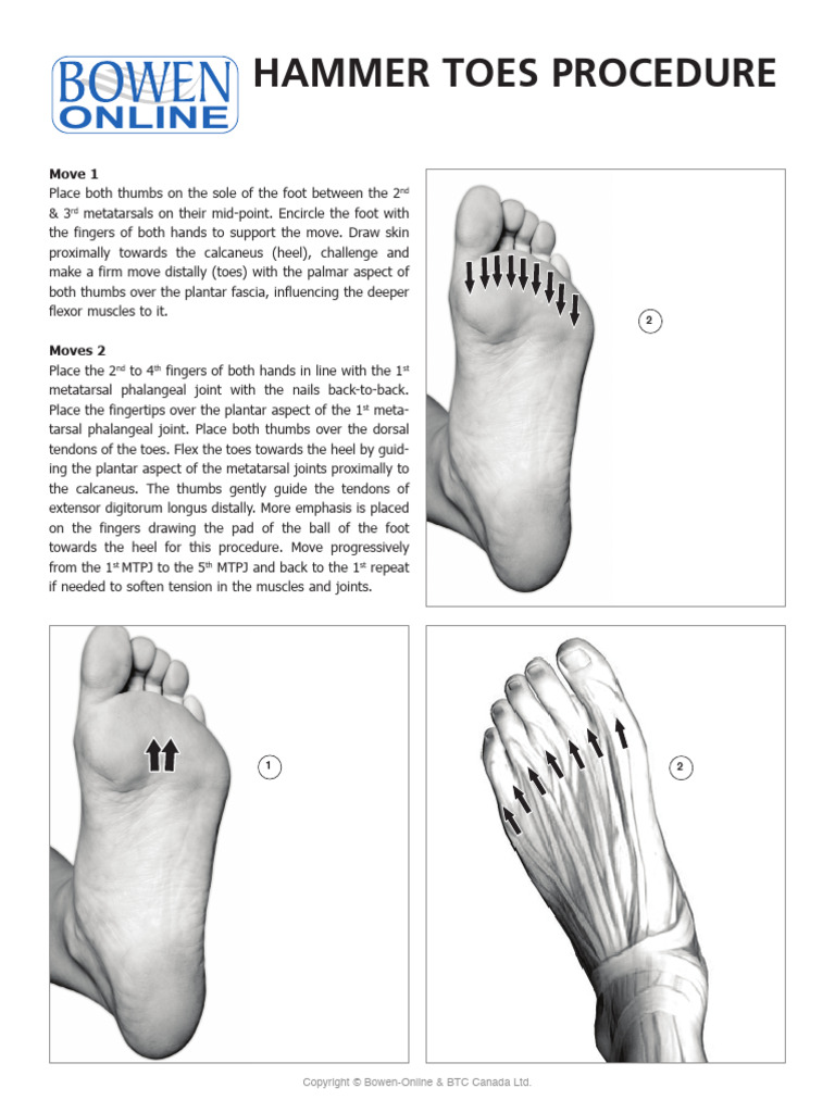 Hammer Toes | PDF