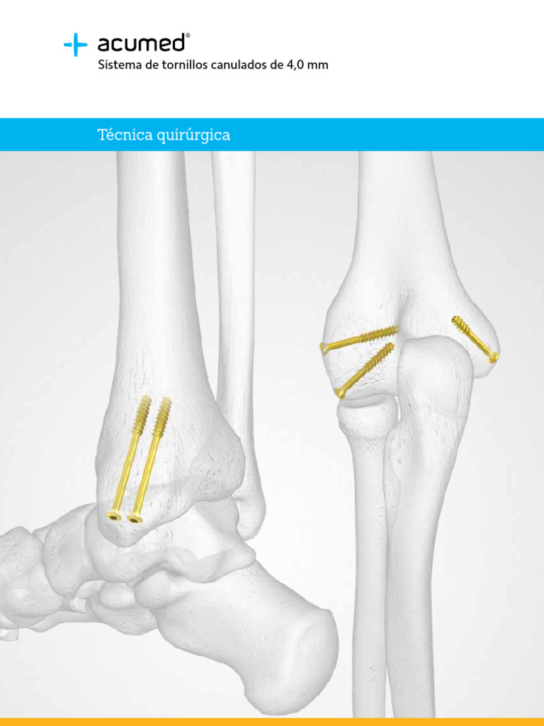 Acumed Surgical Technique ES Cannulated Screw System 4 0 ESSPF00 14 A ...