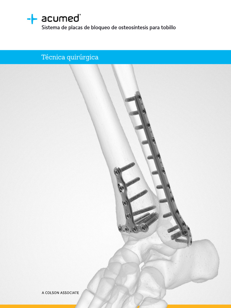 Acumed Surgical Technique ES Ankle Plating System ESLEX00 04 B | PDF ...
