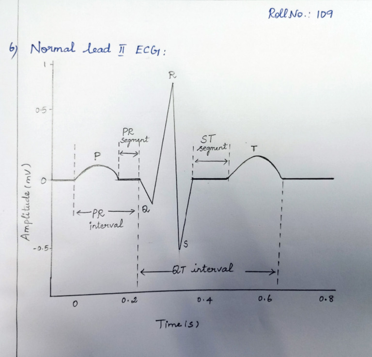 Lead II ECG | PDF