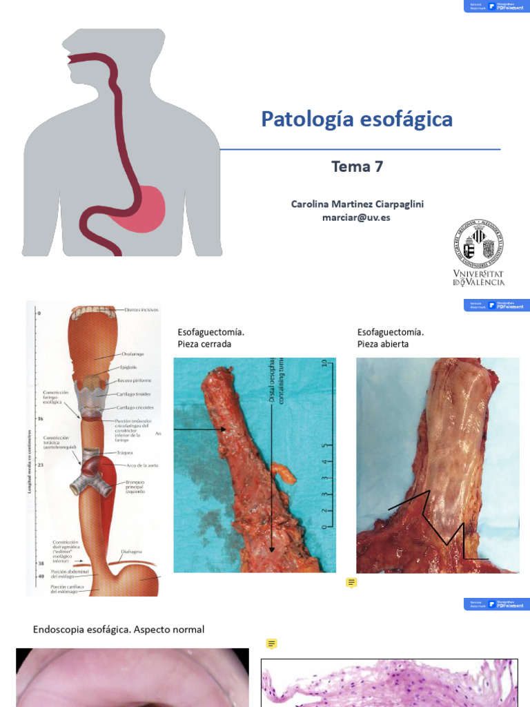 Tema 7 Patología Esofágica | PDF | La enfermedad por reflujo ...