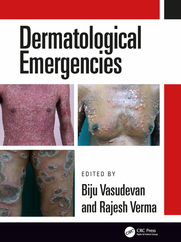 Dermatological Emergencies (Rajesh Verma, Biju Vasudevan) (Z-Library ...