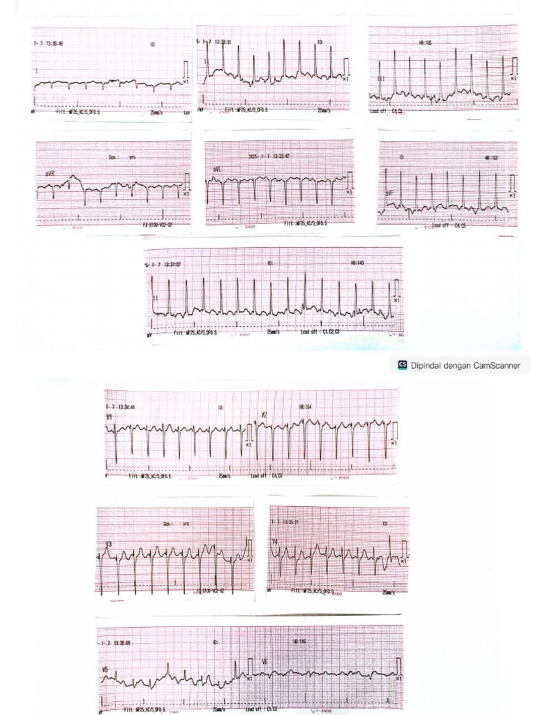 Ekg Arsyila | PDF