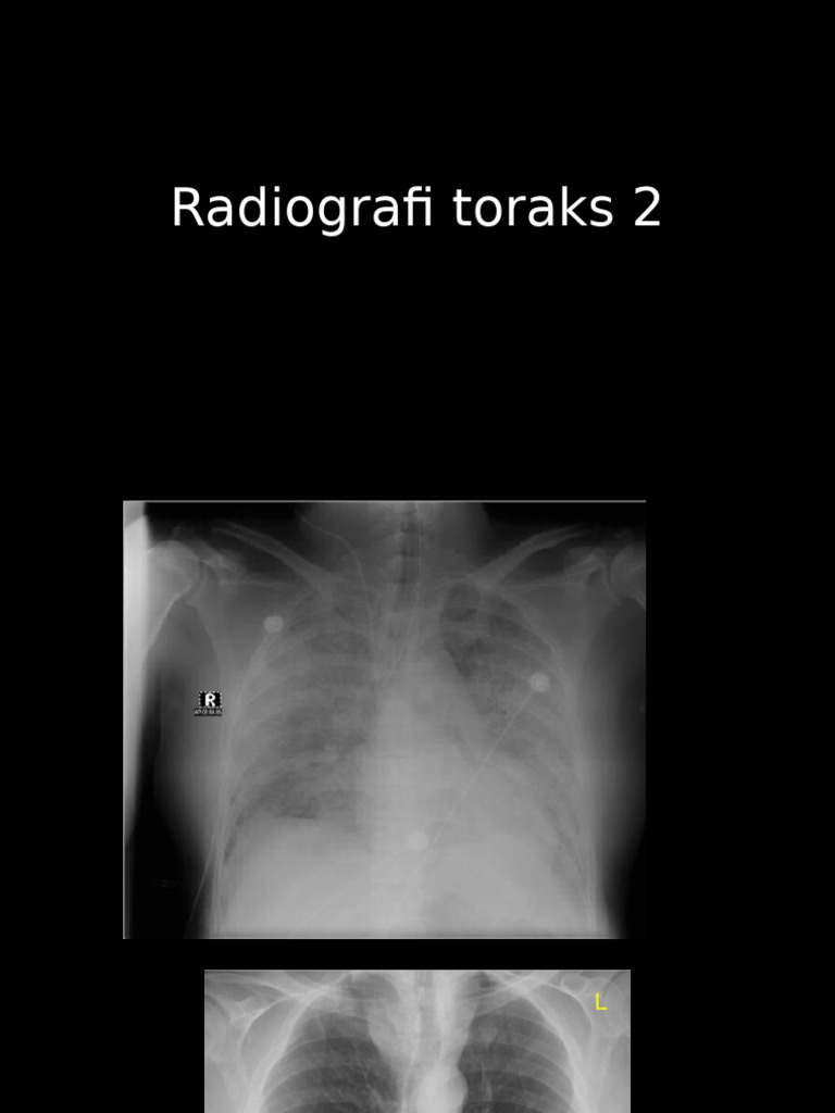 Radiografi Toraks 2 | PDF