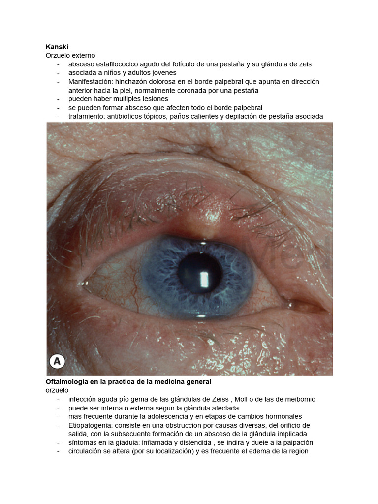 Orzuelo y Chalazión: Diagnóstico y Tratamiento | PDF | Inflamación ...