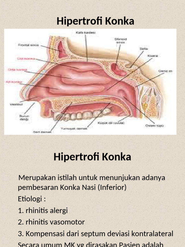 Hipertrofi Konka: Penyebab, Diagnosis, dan Tatalaksana | PDF