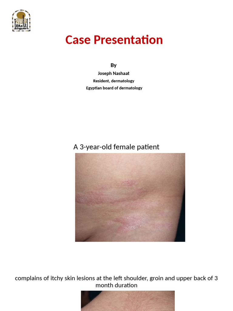 1-Pityriasis Circinata | PDF