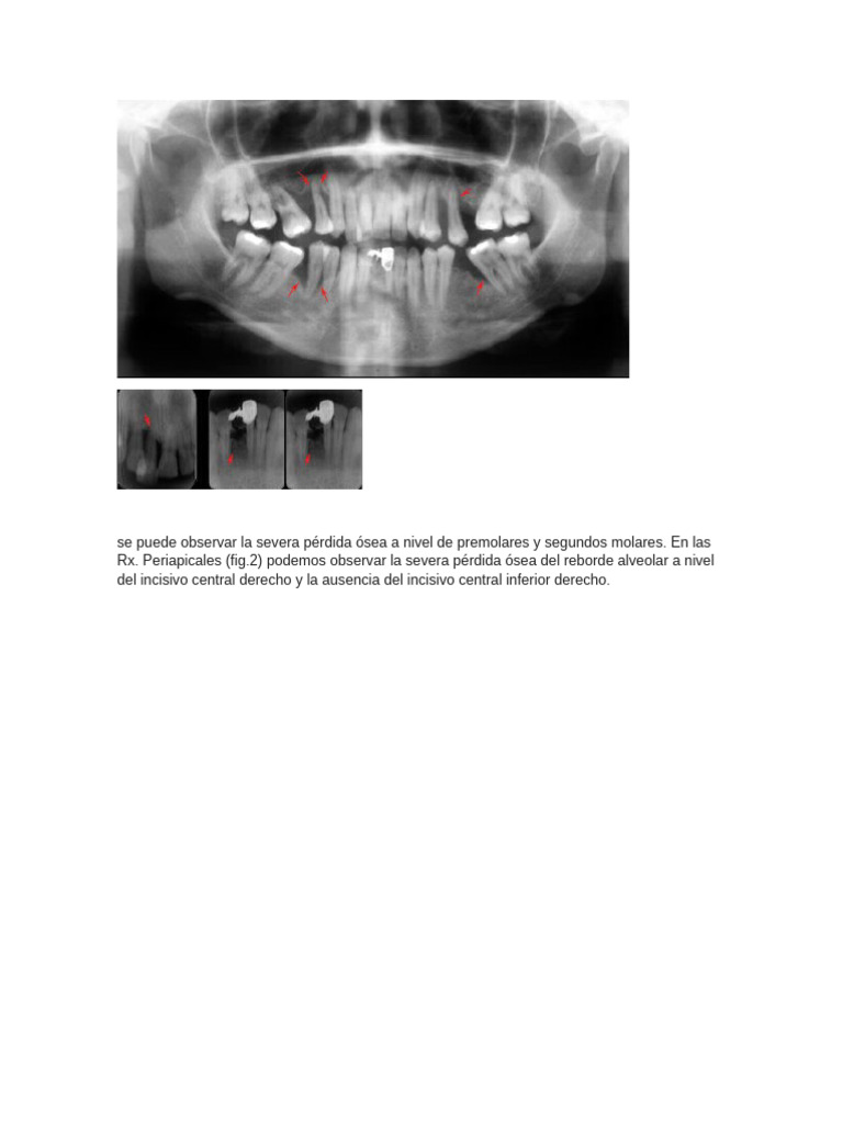 Periodontitis RX | PDF
