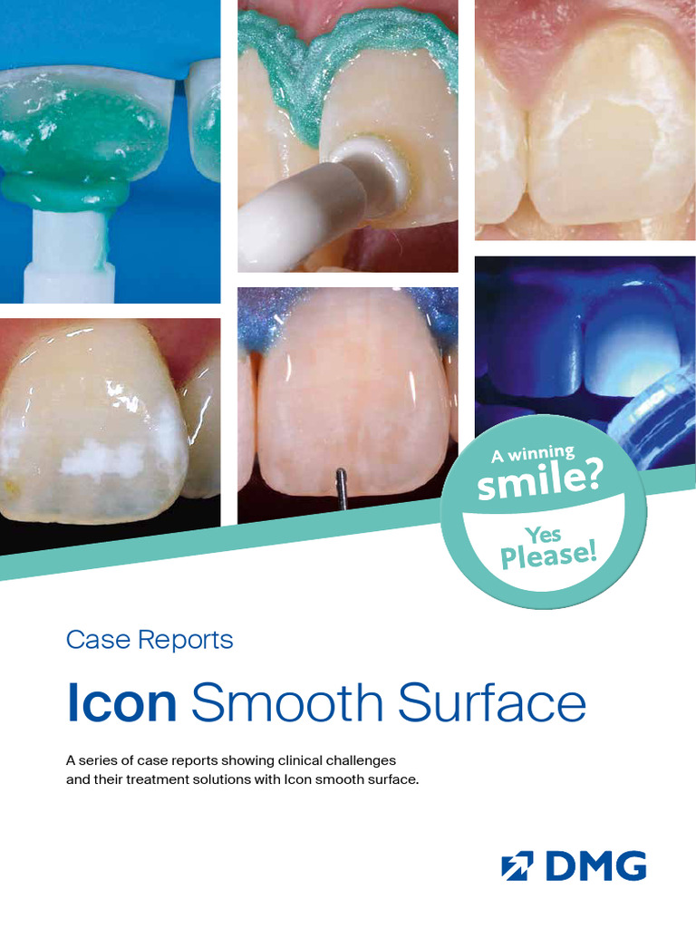 CB - Icon Smooth Surface - Enus - 2023-12 - LAY | PDF | Orthodontics ...