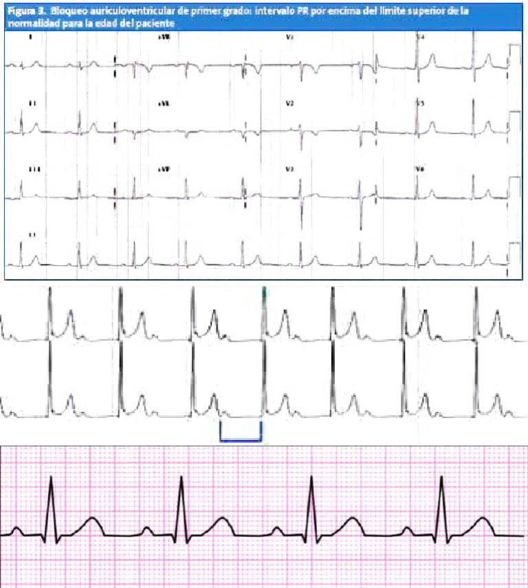 Tarea de bloqueo auriculoventricular 1grado | PDF