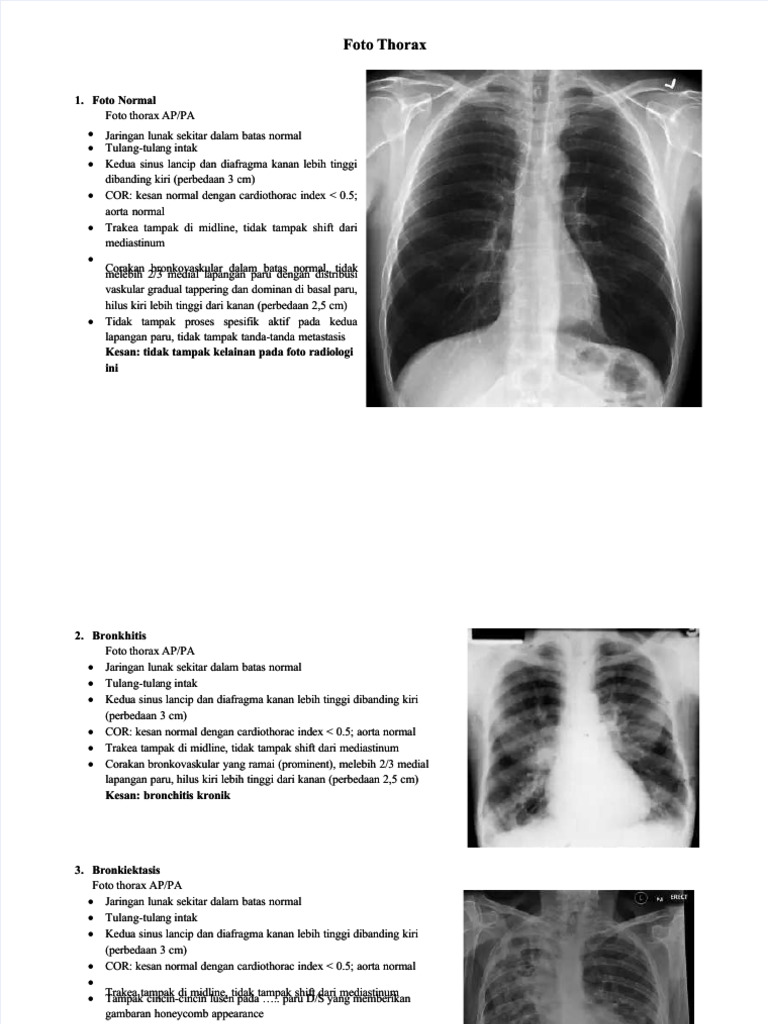 Foto Thorax: Normal, Bronkhitis, TB Paru | PDF