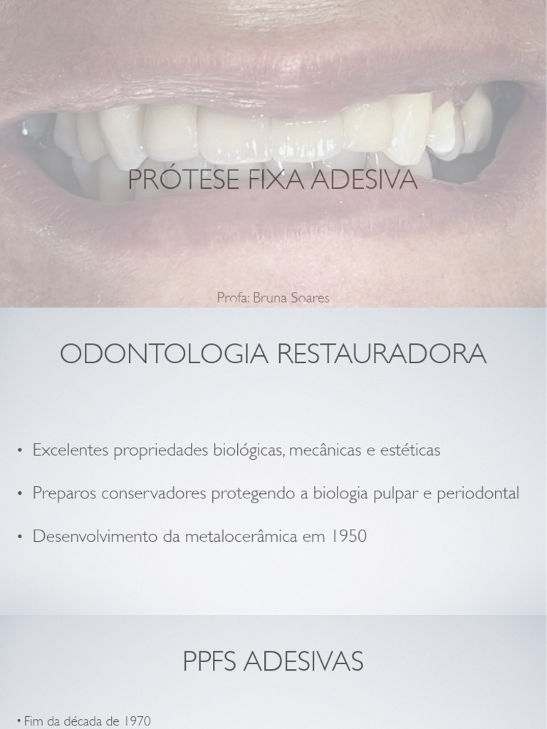 Prótese Fixa Adesiva: Vantagens e Indicações | PDF | Dente humano ...