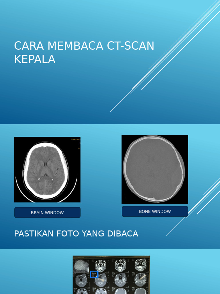 Cara Membaca CT Scan Kepala | PDF