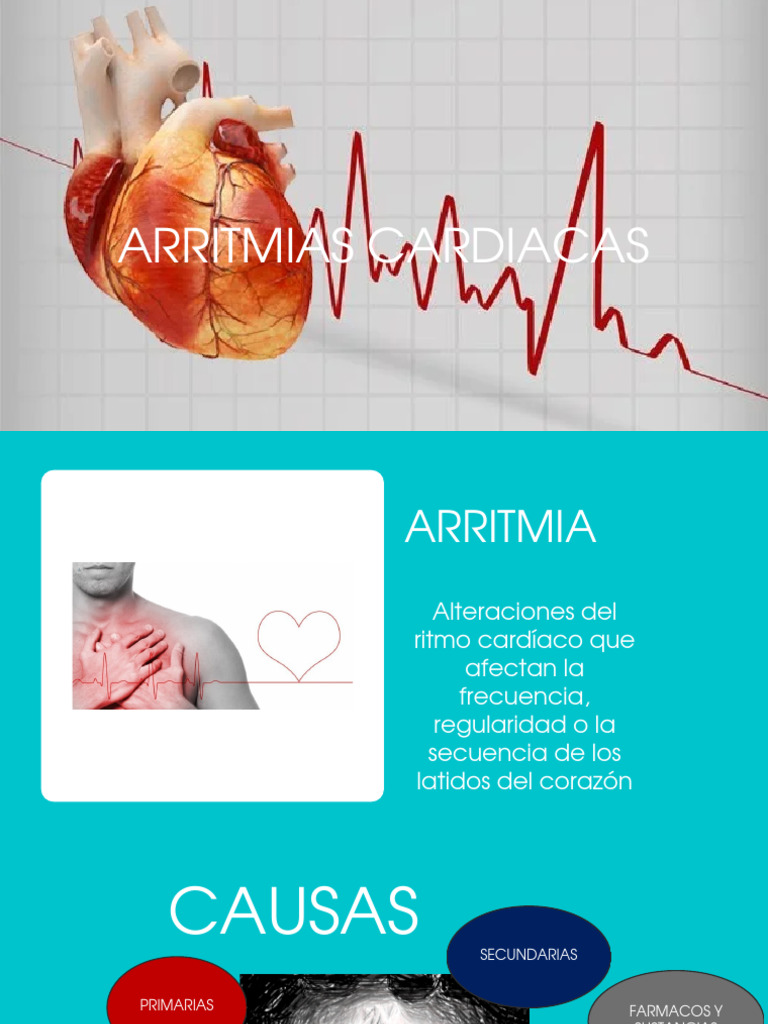 ARRITMIAS - PPTX - 20250124 - 113028 - 0000 | PDF | Cardiología | Fisiología