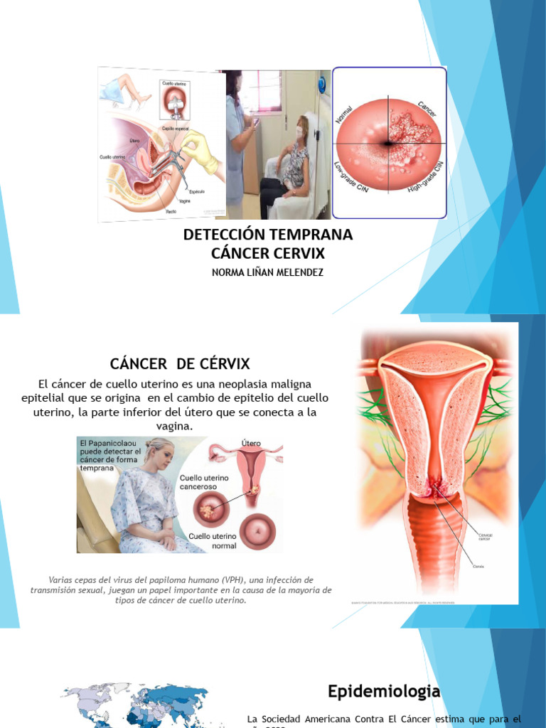 CANCER DE CERVIX | PDF | Cáncer de cuello uterino | Especialidades Medicas